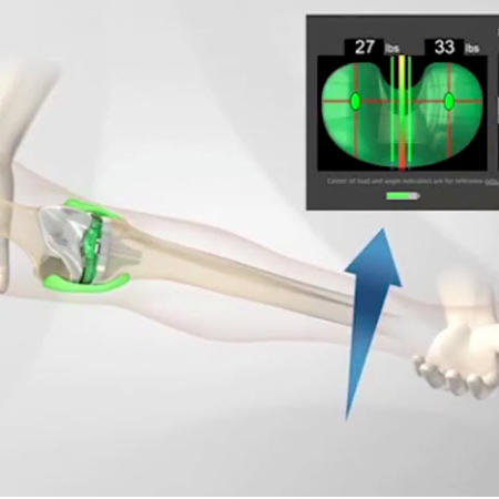 The Pros and Cons of Two Approaches to Hip Replacement: Mini-Posterior ...
