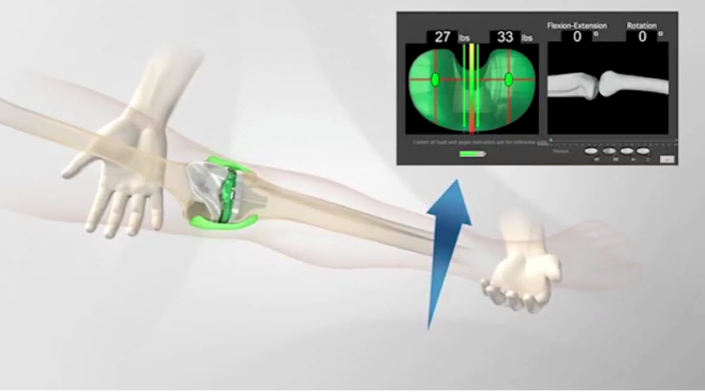 Using Kinematic Sensor Technology for Revision Total Knee Replacement ...