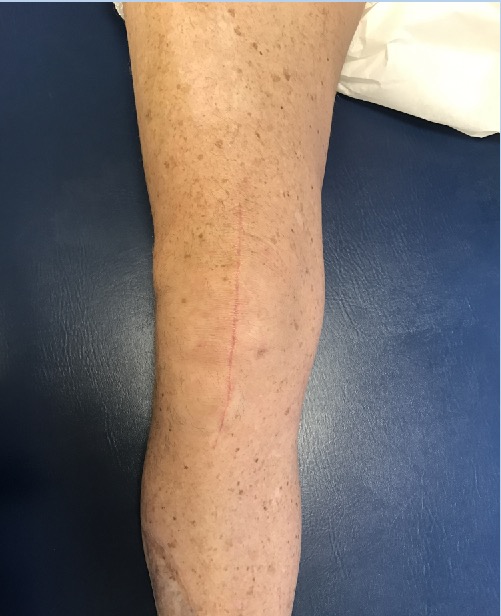 Use of a Subcuticular Suture to Close Hip and Knee Incisions and ...