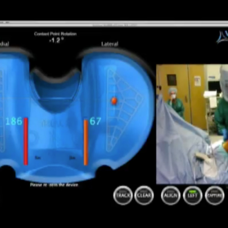 A Bad Total Knee Is Restored with the Use of an OrthoSensor Device