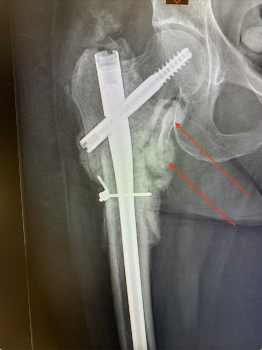 Groin Pain After Hip Pinning