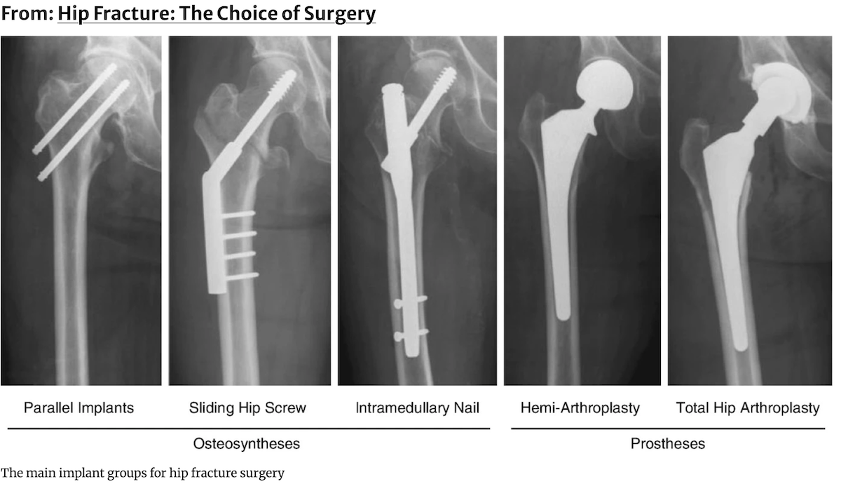 Pain after a hip fracture? Finding out why - The Leone Center for Orthopedic Care
